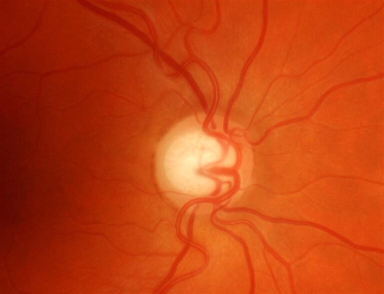 Glaucoma | Alessandra Di Maria